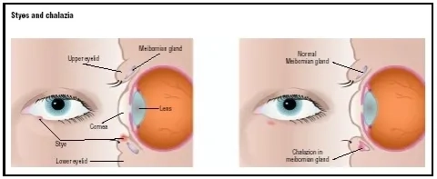 Hordeolum Chalazion Difference